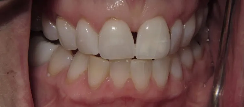 Bioclear Bonding Method | Prairie Village KS